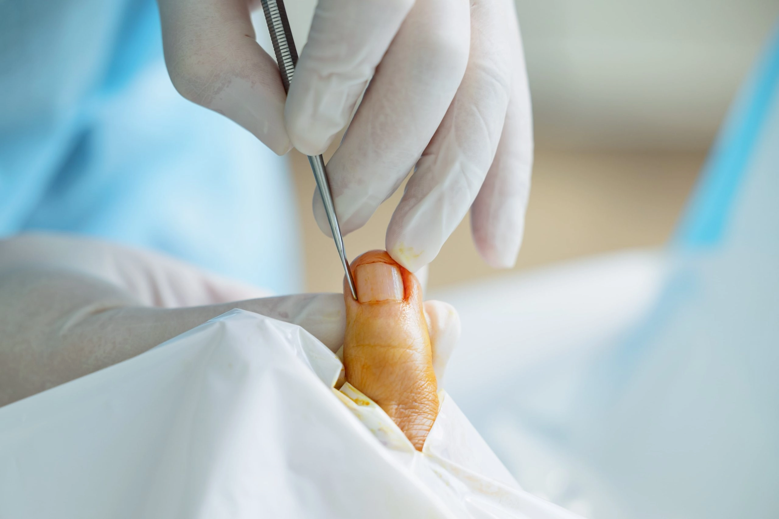 Podiatry for Ingrown Toenails | Healthway Medical Singapore