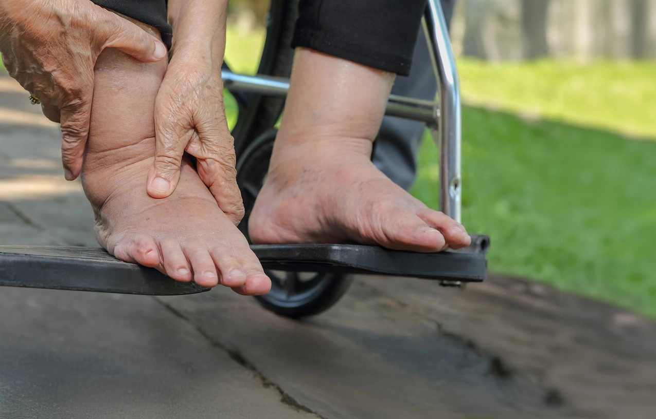 Diabetic Foot Complications | Healthway Medical Singapore