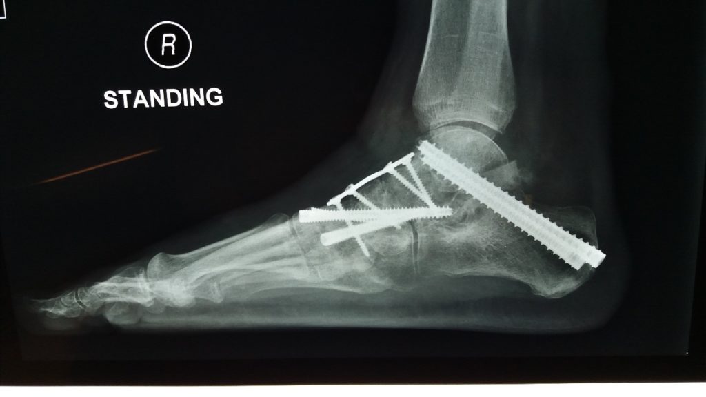 Flat Feet Symptoms Diagnosis And Treatment Healthway Medical